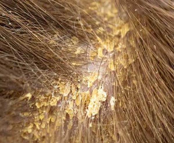 Scalp Psoriasis – Dr. Rai's Skin & Hair Clinic